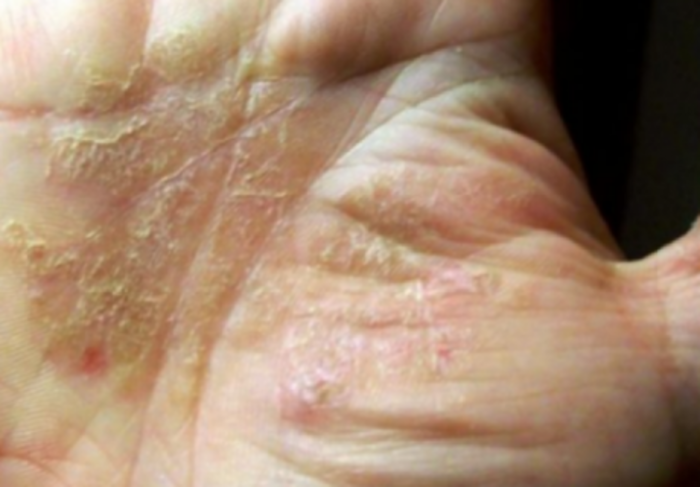 Првите симптоми на рак се појавуваат на дланките - како да ги ...